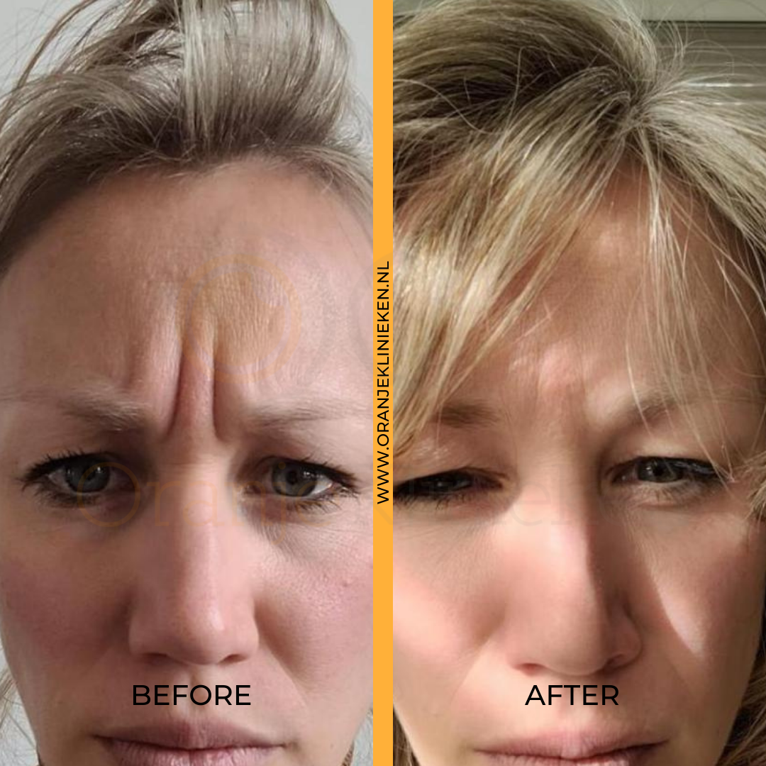Voor- en nafoto's Botox, Fillers en Chirurgie - Oranjeklinieken