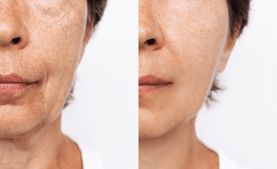 Huidverstrakking: Hoe zit dat? Wat zijn de Oplossingen (Overzicht)